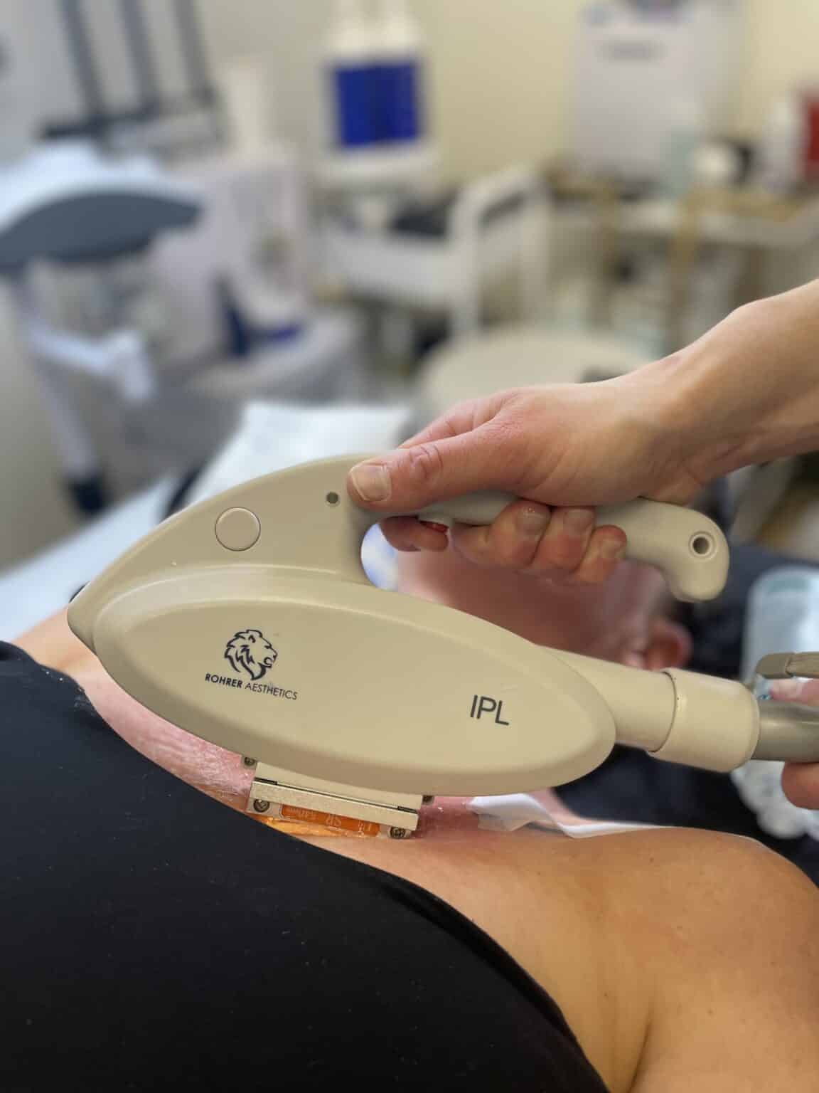 Understanding IPL: The Revolutionary Skin Treatment - Aspen Aesthetics ...